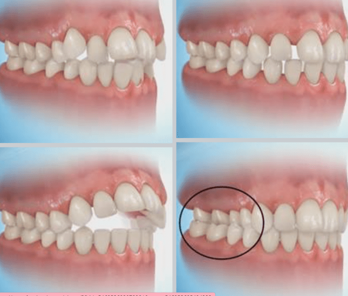 Underbite vs Overbite: ABC Orthodontics : ABC Orthodontics